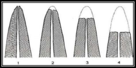 Schematic Illustration Of Lavender And Malmgren Classification For Earr Download Scientific