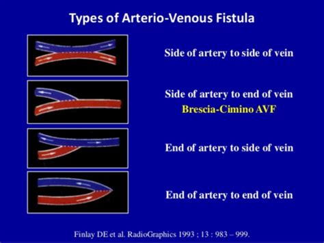 Upper Extremity Venous Mapping