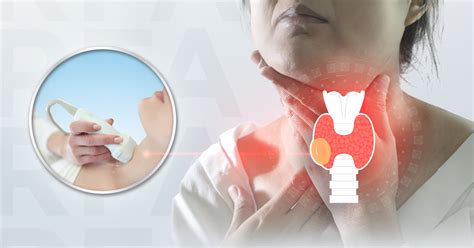 Thyroid Radiofrequency Ablation Package A Minimally Invasive