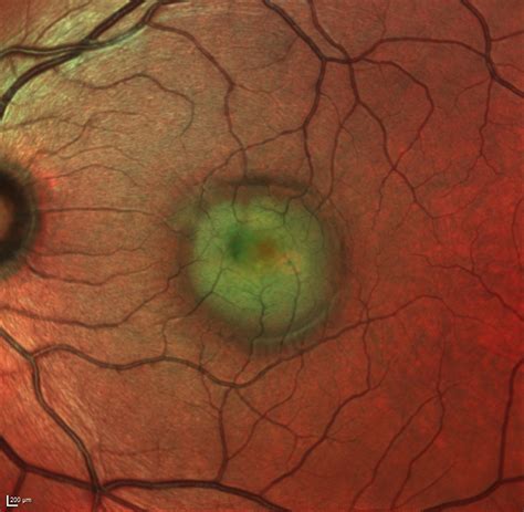 Choroidal Neovascular Membrane