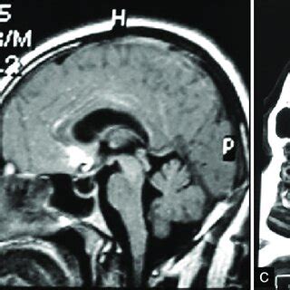 A Preoperative Plain Axial Computed Tomography Scan Showing