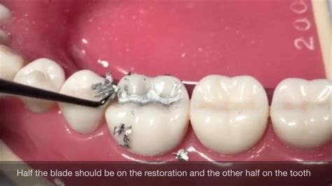 Class I Cavity Preparation For Amalgam Maxillary Molar 26 51 Off