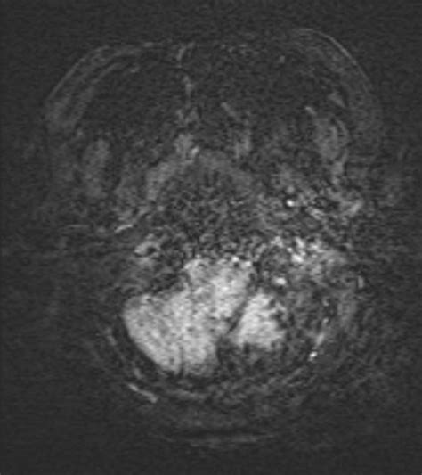Cerebral Venous Infarct Radiopaedia 53627 59685 Axial Swi Nc Commons