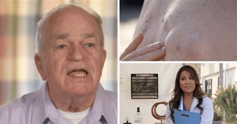 Where Is Ralph Now Dr Pimple Popper Gives Patient Who Is A Cyst Factory Hope After Failed