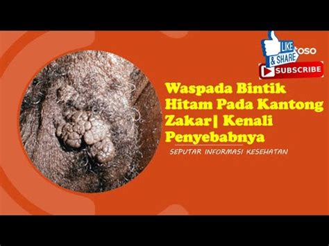 WASPADA BINTIK HITAM PADA KANTONG ZAKAR| KENALI PENYEBABNYA - YouTube