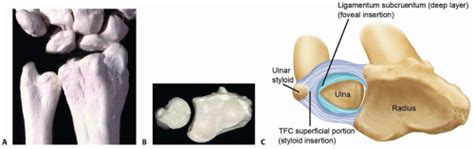 Resection Arthroplasty Of The Distal Radioulnar Joint Musculoskeletal Key