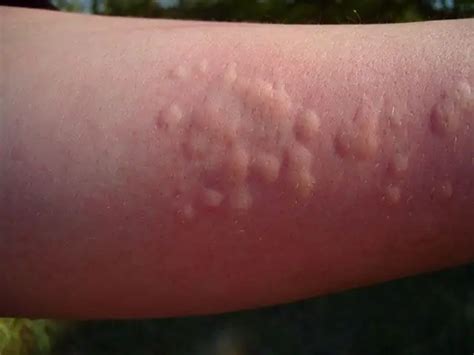 Urticaria Symptoms Causes Treatment Diet Health 2025