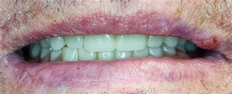 Dentist Downers Grove Il Dental Cure Smile Gallery