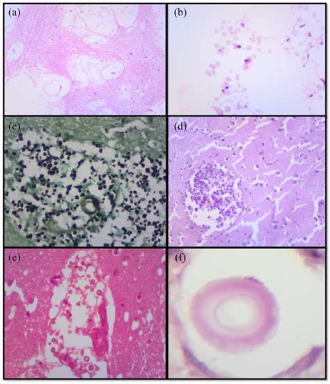 A F Cryptococcal Infection A Soap Bubble Appearance And B