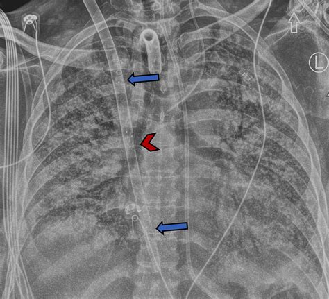 Extracorporeal Membrane Oxygenation Ecmo Catheter