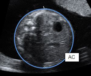 Ultrasound Scanfetal Growth Scan Patient Information Brochures