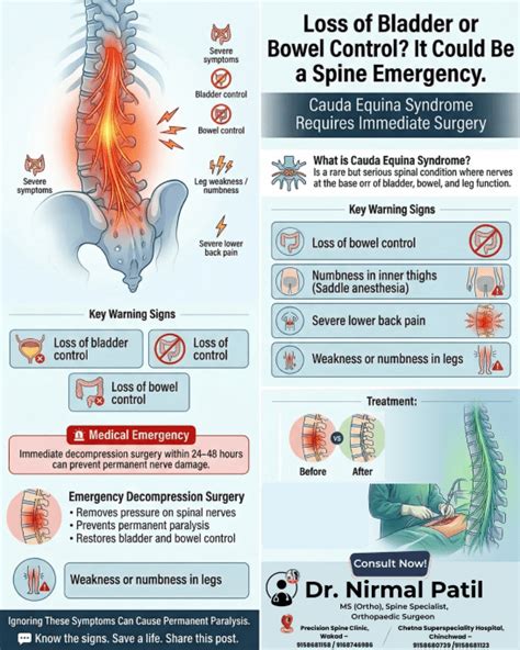 Cauda Equina Syndrome Surgery In Wakad Dr Nirmal P 247