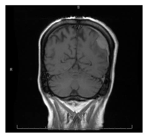 Mri Brain Coronal Section A And Transverse Section B Showing