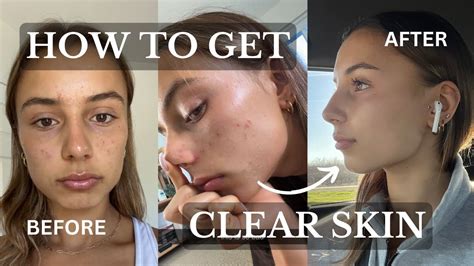 Clear Skin Before And After
