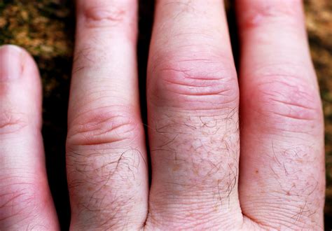 Mari Mengenal Penyebab Dan Faktor Risiko Terjadinya Rheumatoid