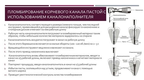 Пломбирование корневого канала пастой ручным методом и с использованием ...