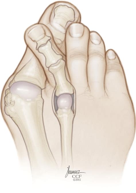 The Crossover Toe And Valgus Toe Deformity Foot And Ankle Clinics