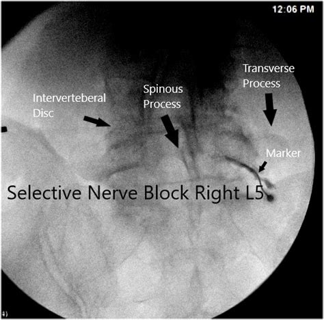 Case Study Selective Nerve Root Block In 70 Yr Old Female