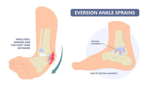 Ankle Dislocation Over 136 Royalty Free Licensable Stock Illustrations