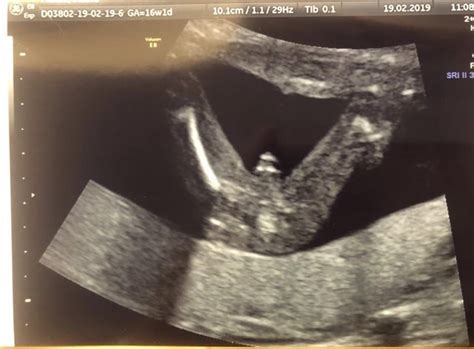 I Recently Went To A Gender Reveal Scan Pretty Easy To Guess What Im Having R Predaddit
