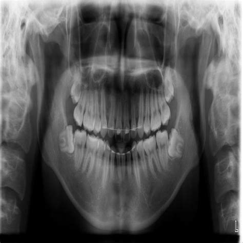 Cariesseg Instance Segmentation Dataset V3 2024 07 30 9 21am By