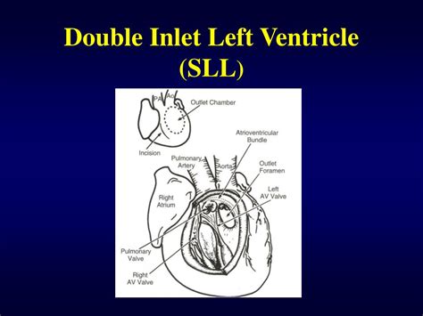 Ppt Double Inlet Ventricle Powerpoint Presentation Free Download