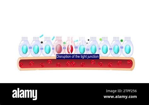 Leaky Gut Syndrome Difference Between Healthy Cells And Inflamed Intestinal Cells Gut Barrier