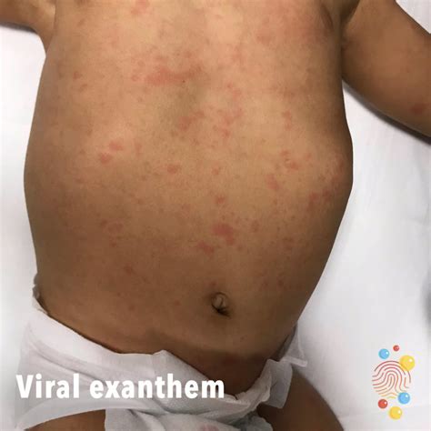 Viral Rash