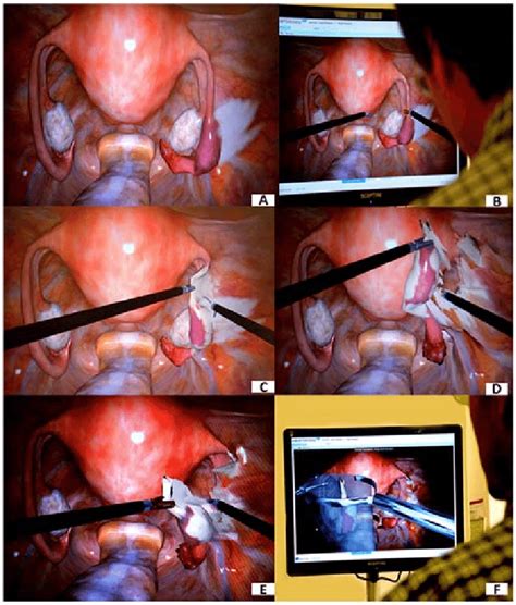 A F The Laparoscopic Salpingectomy Task For Ectopic Pregnancy On