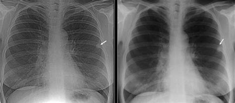 Calcified Granuloma Definition Causes Symptoms Diagnosis And Treatment