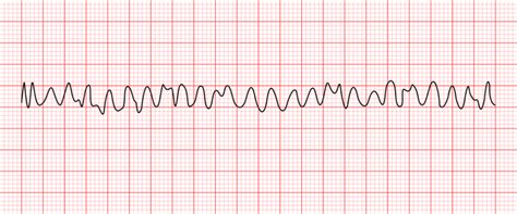 Fibrillazione Ventricolare Ecg E Trattamento