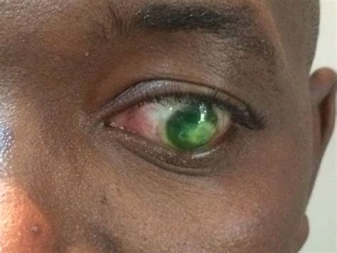Nafl Pattern With The Semi Scleral Lens On The Left Eye Download