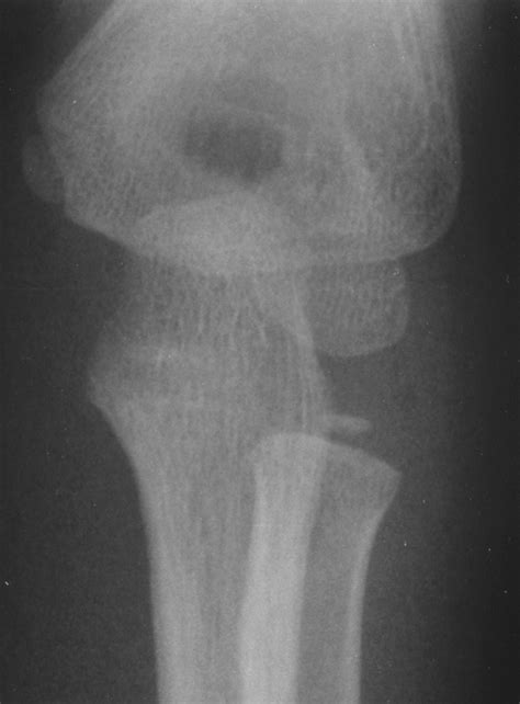 Large Joint Effusion Elbow Discount Sellers