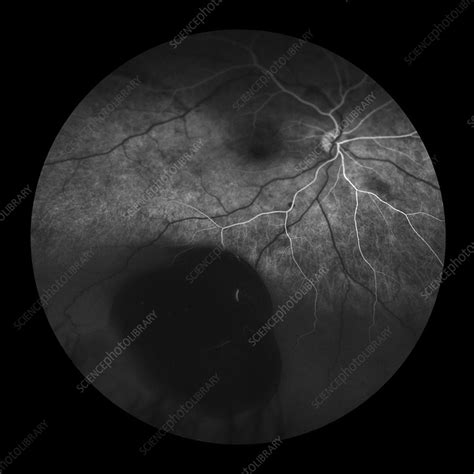 Choroidal Melanoma 2 Of 8 Stock Image C030 6964 Science Photo Library