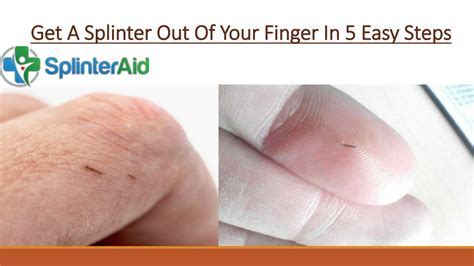 PPT Get A Splinter Out Of Your Finger In 5 Easy Steps PowerPoint Presentation ID 10806203