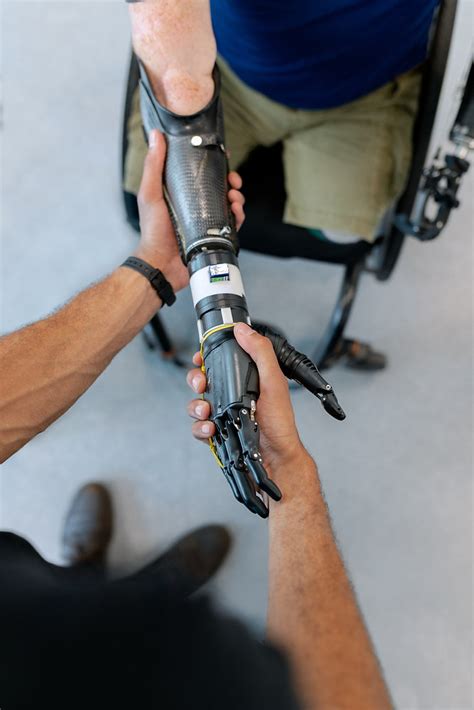 Upper Limb Prosthetic