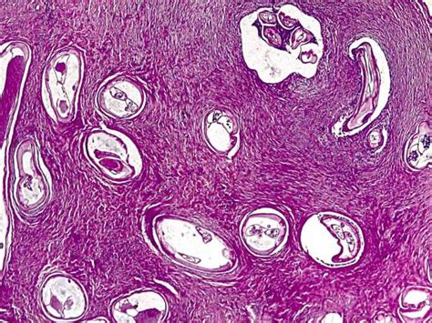 Onchocercoma Of The Scalp A Case Report Pmc
