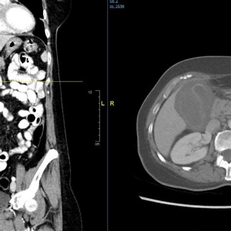 Computed Tomography Showing Axial And Coronal Cut Of Duplication Download Scientific Diagram Computed Tomography Showing Axial And Coronal Cut Of Duplication Download Scientific Diagram