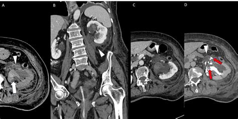 Contrast Enhanced Abdominal CT A Axial Unenhanced B And C Coronal