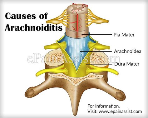 7 Best Arachnoiditis An Insidious Incurable Disease Of The Spine And