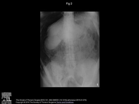 Intraoperative Pneumothorax Presenting As Abdominal Distention Ppt Download