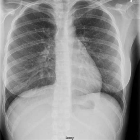 Chest X Ray Anteroposterior View Showing Normal Findings Download Scientific Diagram