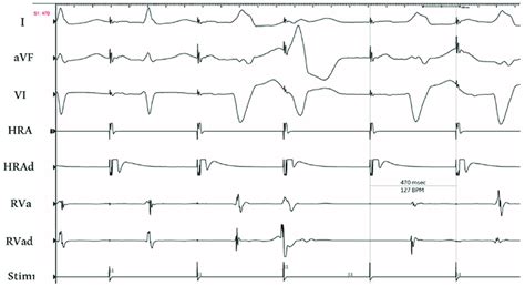 Intracardiac Electrogram Showing Initiation Of Left Bundle Branch Block