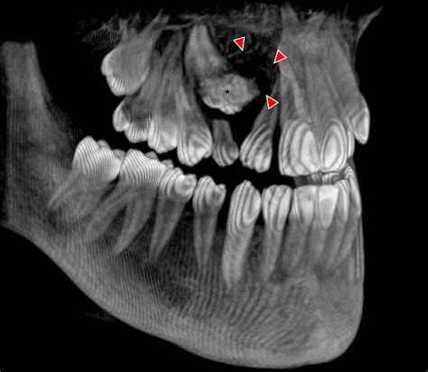 Calcifying Epithelial Odontogenic Tumor Full Text Pindborg Tumor In