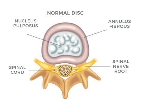 Sciatica London Bridge Sports Medicine