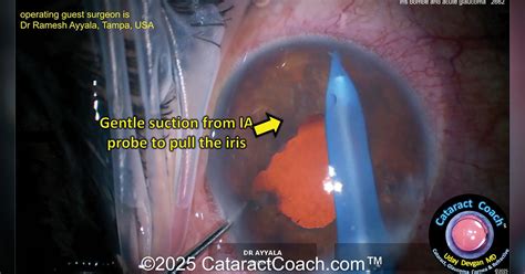 Stepwise Approach Needed To Manage Iris Bombé With Acute Glaucoma Cataract
