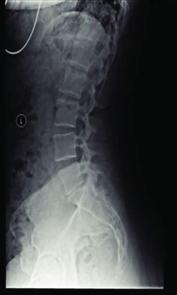 A Lumbar Radiograph With Narrowing Of The L5 S1 Disc Space This Download Scientific Diagram