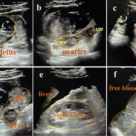 Transabdominal Ultrasound Images Rovright Ovary Lovleft Ovary