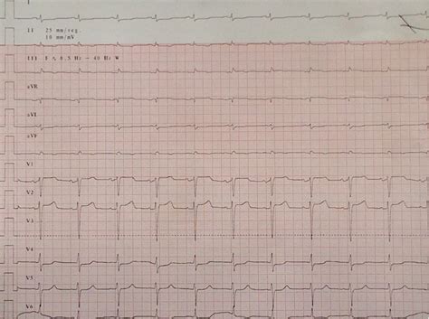 Ecg 44 Asociado Principalmente A Cardiopatía Isquémica Cardio Science