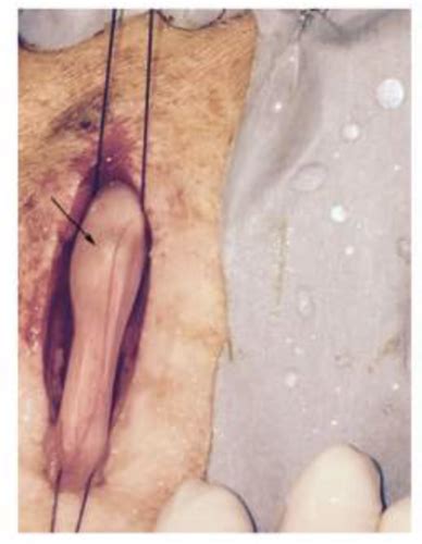 Lasx Urolithiasis Flashcards Quizlet